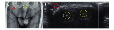 Imaging Findings Supportive Of The Diagnosis Of Calciphylaxis Plain