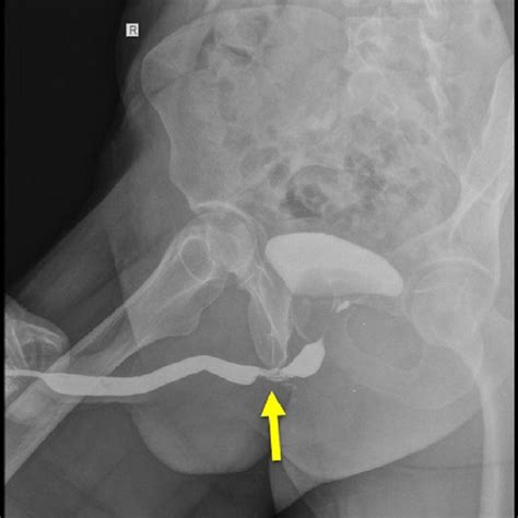 An Ascending Urethrogram Showing A 2 Cm Short Annular Stricture Segment