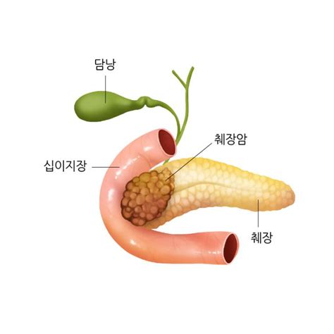 걸리면 거의 무조건 죽는 병들 포텐 터짐 최신순 에펨코리아