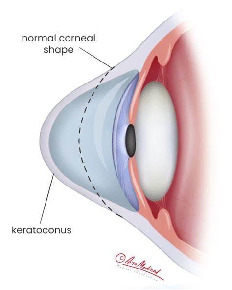 Keratoconus Symptoms Diagnosis And Treatment