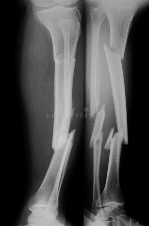 X Ray Image Of Broken Leg Ap And Lateral View Stock Image Image Of