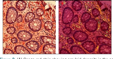 Figure 2 From Systemic Amyloid A Protein Amyloidosis With