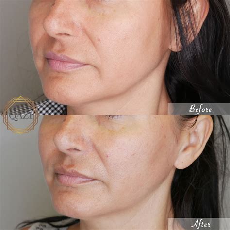 Pdo Thread Lift Non Surgical Facelift Artofit