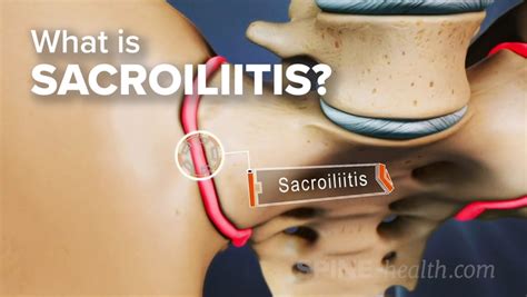 Understanding Sacroiliitis Is It A Type Of Arthritis