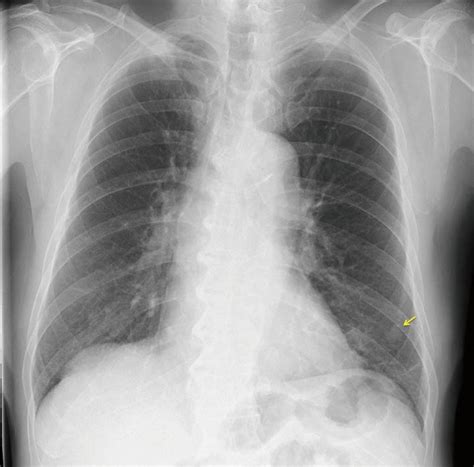 Lingular Segmentectomy And Left Lower Lobectomy Via Unique Bronchial