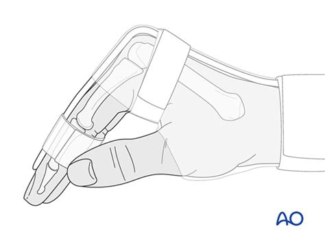 Collateral Ligament Repair For Dislocation Of The Proximal