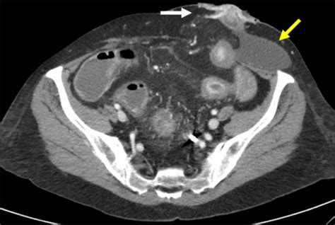 Parastomal Variceal Bleeding Attributed To Obstructive Pathology