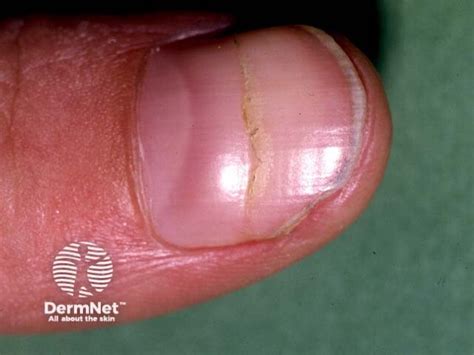 Nail Disorder Images