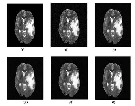 Results Of Image Filtering Techniques For Mri Image A Original Image Download Scientific