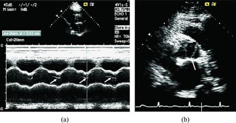 Bicuspid Aortic Valve M Mode