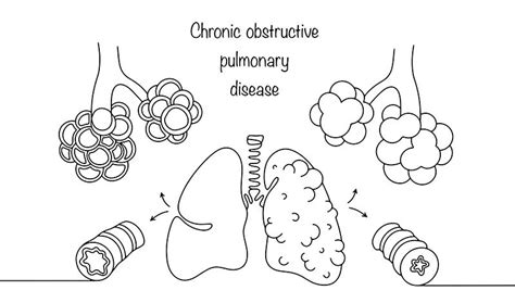 Chronic Bronchitis Symptoms Hint At Benefits Of Mepolizumab In Copd