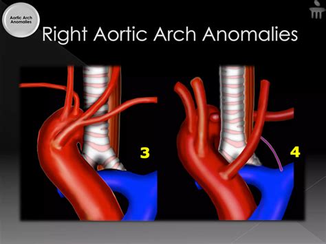 Aortic Arch Anomalies Pdf