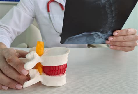 Benefits Vs Risks Of Disc Replacement Surgery Painscale