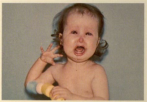 Medicinehallermannstreiff Syndrome Handwiki