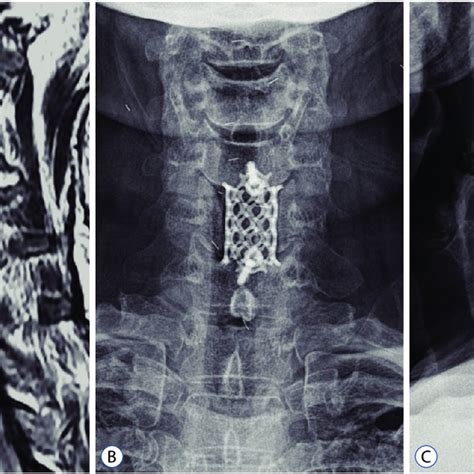 A 64 Year Old Man Who Underwent C3 4 Corpectomy And Reconstruction With