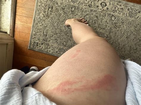 Has Anyone Had Similar Blisters Rshingles