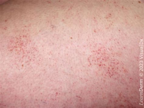 Petechiae Learnderm