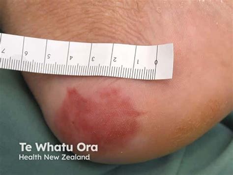 What Are Bed Sores Caused By