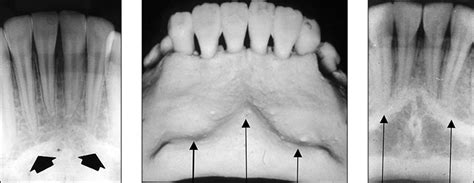 Genial Tubercle Radiograph