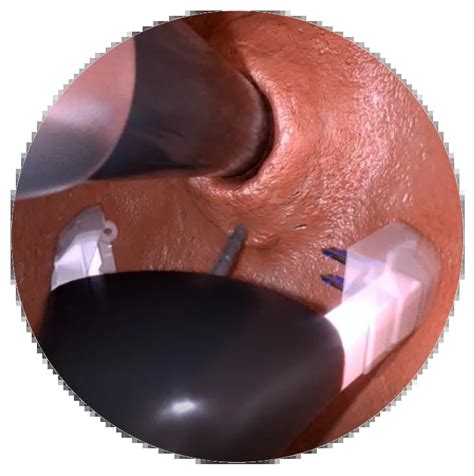 Gerdx Reflux Treatment Gastroenteroloji Doktoru Prof Dr Yusuf Akcan