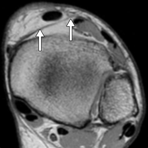 Retinacula Of The Foot And Ankle Mri With Anatomic Correlation In
