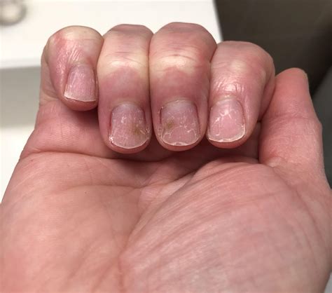 Brown Spots On Fingernails