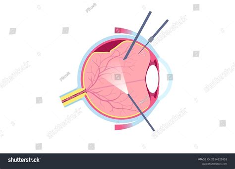 Vitrectomy Surgical Procedure Ophthalmology Clinic Remove Stock Vector