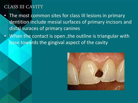 Modifications Of Cavity Preparations In Pediatric Dentistry Pptx