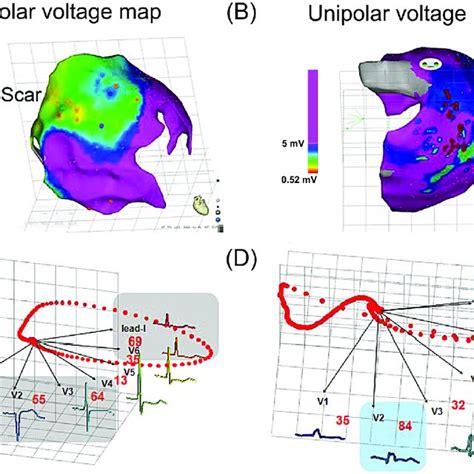 A B 3d Electroanatomic Map And C D Corresponding Reconstruction Download High Quality
