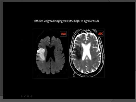 Diffusion Weighted Brain Imaging Ppt