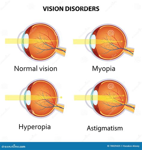 Common Vision Disorders Stock Vector Illustration Of Disorder 78029425
