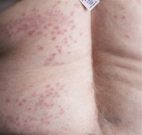 Diabetes Skin Symptoms