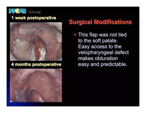 20 Newrestoration Of Soft Palate Defects Pdf