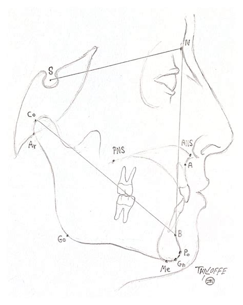 Impact And Stability Of Mandibular Setback After Intraoral Vertical