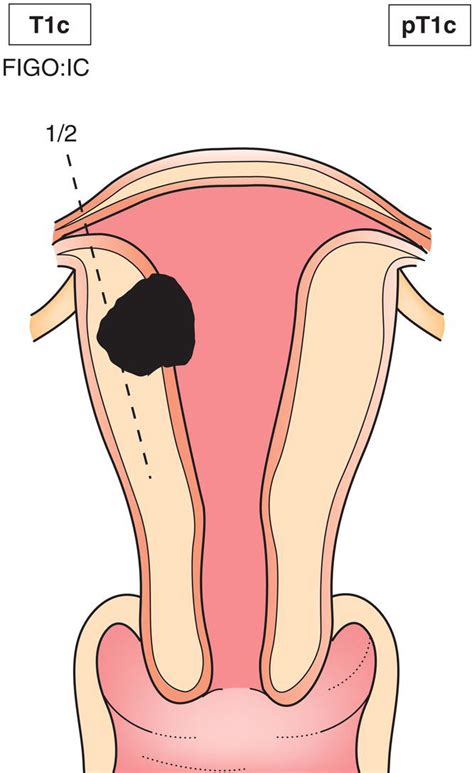 Uterine Sarcomas Leiomyosarcoma Endometrial Stromal Sarcoma