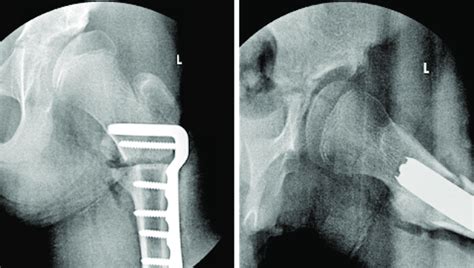 Intraoperative Fluoroscopy Demonstrating Confirmation Of Internal