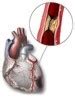 ¿qué Es Un Infarto Al Miocardio ¿cuáles Son Los Sintomas Antes