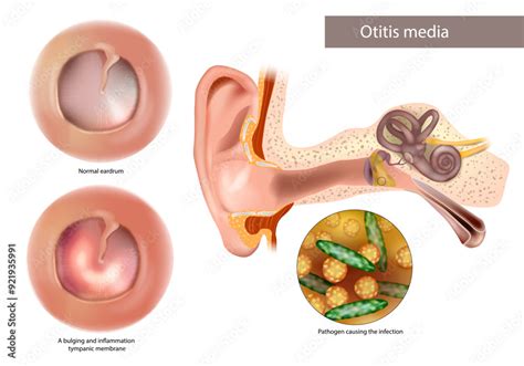 Otitis Media Or Chronic Suppurative Pathogen Causing The Infection Normal Eardrum And Bulging
