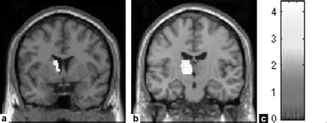 Figure Shows Gray Matter Volume Deficits In Schizophrenia Patients N 5 Download Scientific