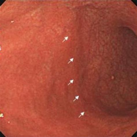 Classification Of An Endoscopically Evident Atrophic Pattern The