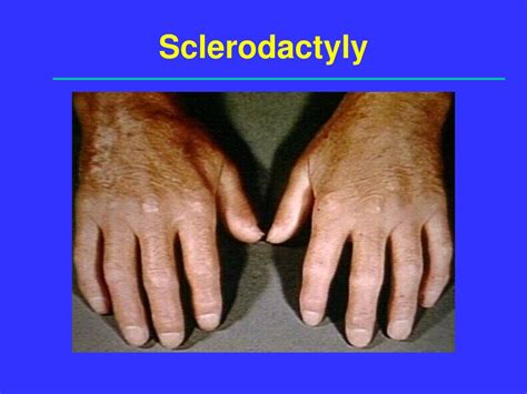 Ppt Scleroderma Powerpoint Presentation Free Download Id2762083