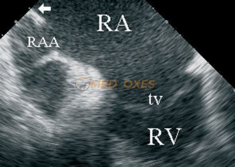 Cardiac Structures In Intracardiac Echocardiography Medfoxes