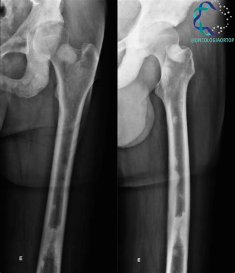 Fratura Patológica Parte Ii Oncologia Ortopédica