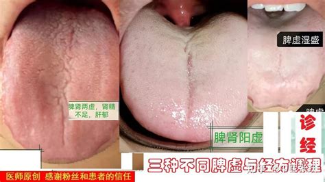 三种不同脾虚和对应经方调理 知乎