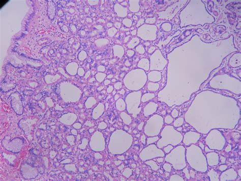Proton Pump Inhibitor Injury Leading To Fundic Gland Polyp