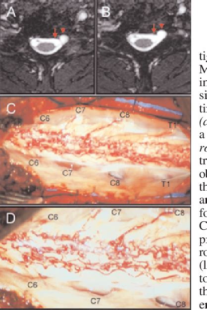 Figure 1 From Multiple Root Avulsions From The Brachial Plexus Case