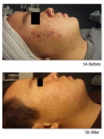 Red Light Therapy Before And After Results Scars Acne Wrinkles And More