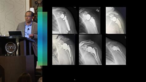 Shoulder Innovations Inset™ Shoulder Implants