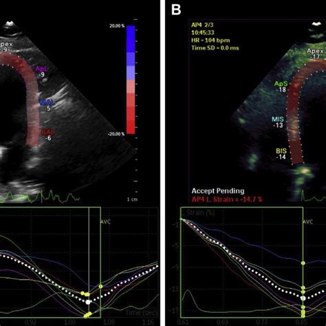 A Strain Echocardiogram Prior To Ablation Demonstrating Left Download Scientific Diagram
