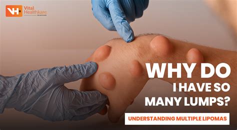 Multiple Lipomas On The Body Causes Symptoms And Treatment Options